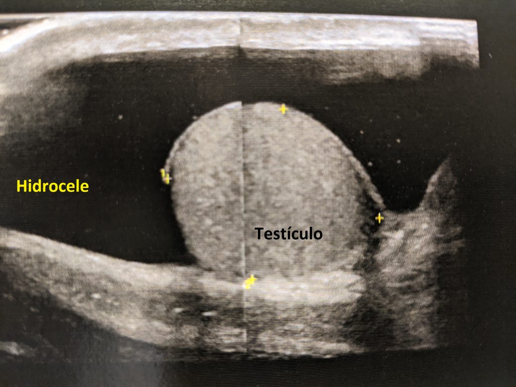 Hidrocelectomia Antes Depois Testicular Hydrocele: Recovery And
